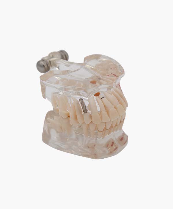 Standard Pathological Missing Tooth Model - Feiman
