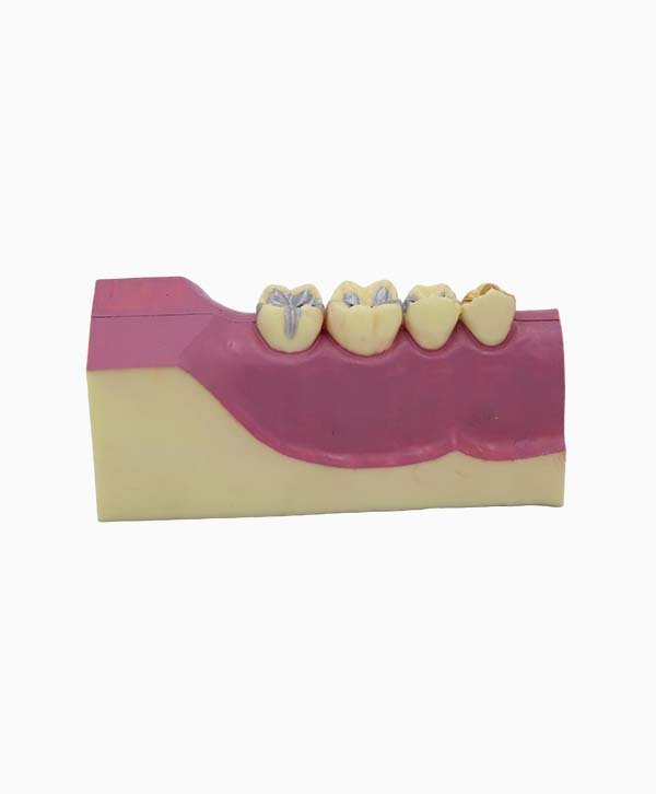 2 Times Right Lower Tooth Detachable Model - Feiman